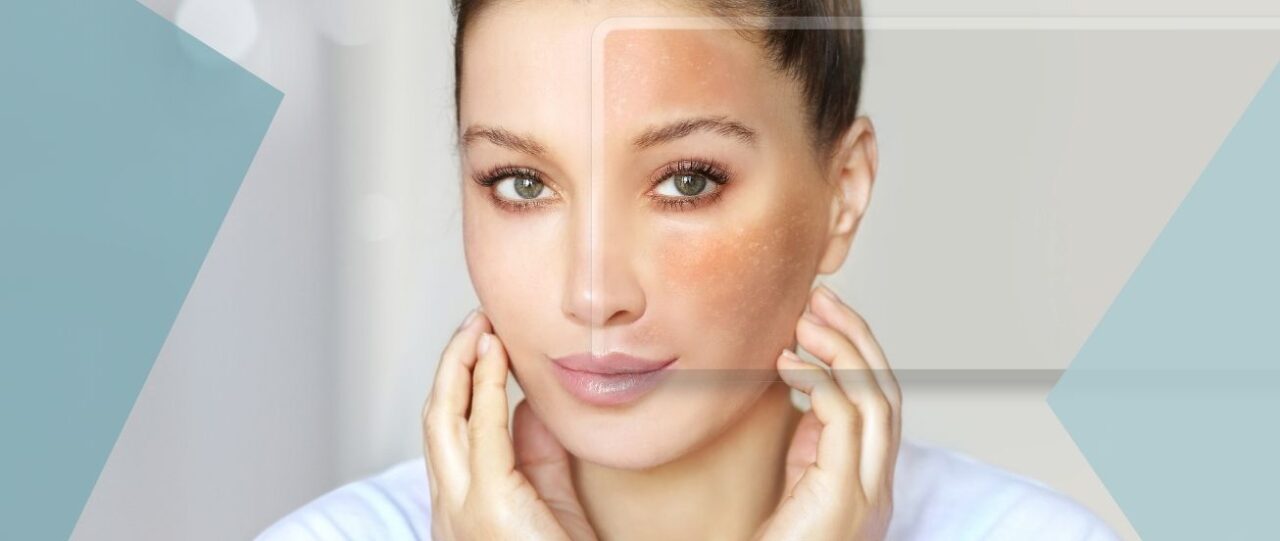 Melasma y Manchas: Soluciones Efectivas en Vitasthetic